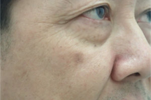 Stop Doing Pico Laser on Melasma | The Ogee Clinic SG